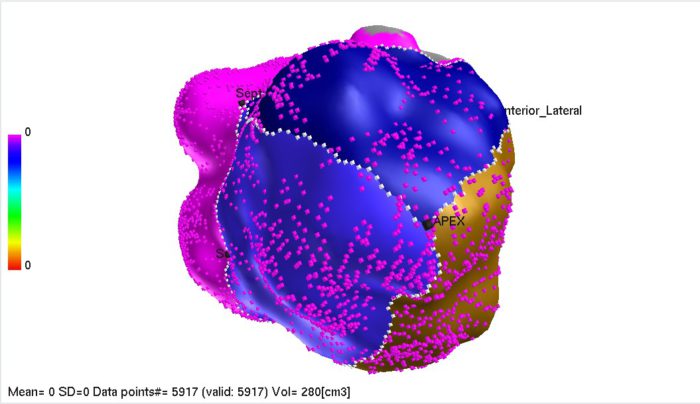 Performing 17 Segments Lv Segmentation Pawel Kuklik Phd